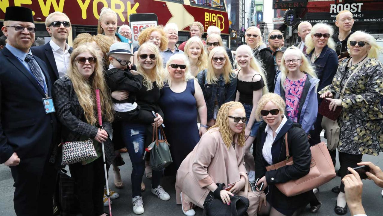 Raising awareness about albinism around the world - UN Today
